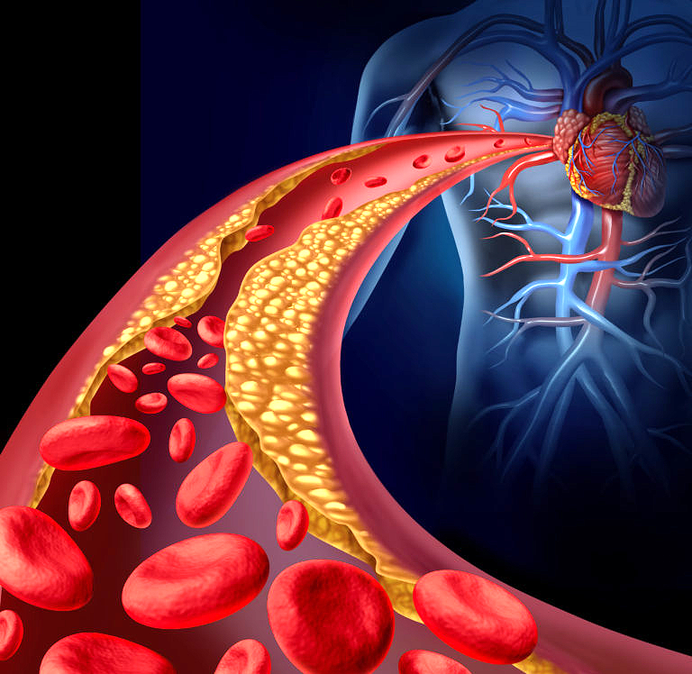 Does Cholesterol Cause Heart Disease 5 Reasons Why Cholesterol Is Good does-cholesterol-cause-heart-disease-5-reasons-why-cholesterol-is-good